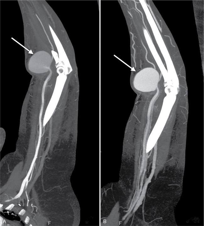 Renal vascular imaging | Radiology Key