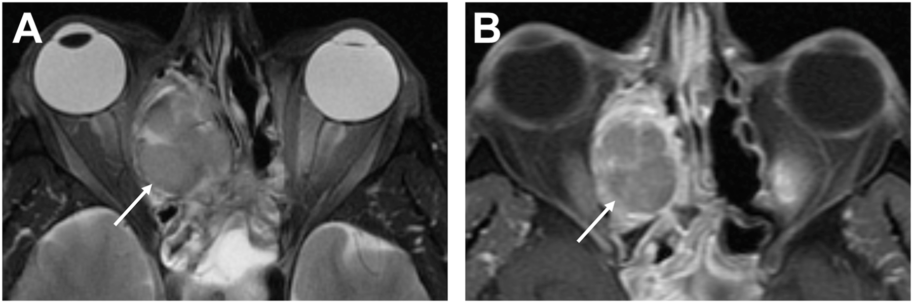Rare Head and Neck Tumors | Radiology Key