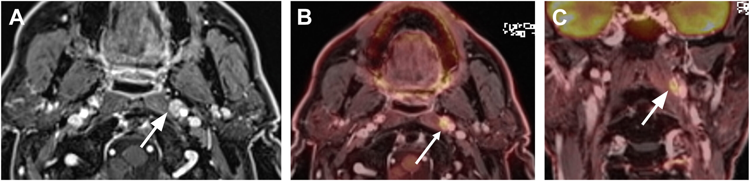 18-FDG-PET Imaging in Head and Neck Cancer: Current Application ...